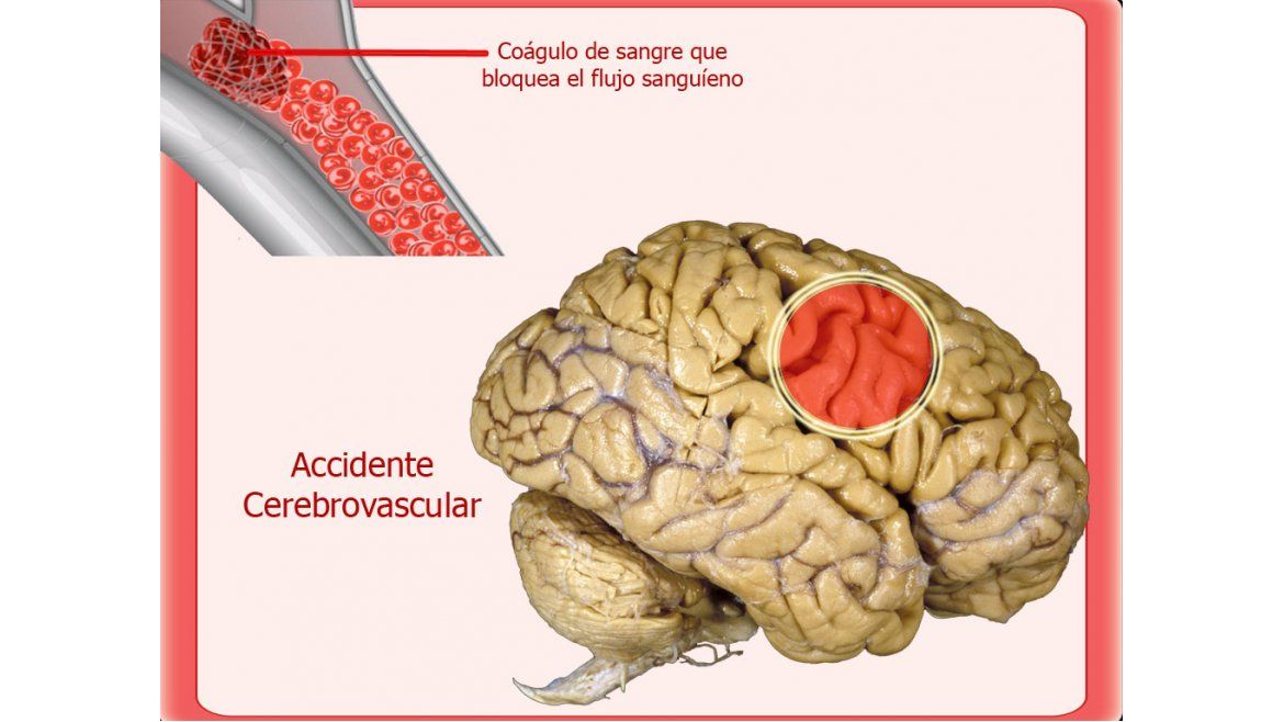 Aconsejan evitar los factores de riesgo de ACV y actuar con rapidez ...