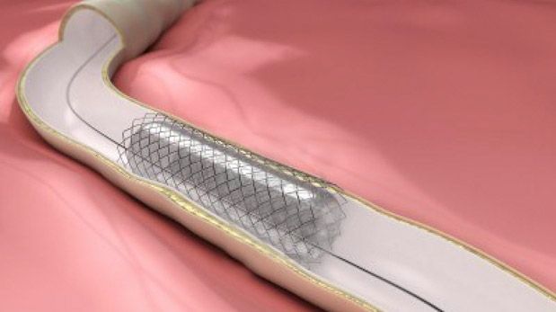 La creación del “stent” cumple 25 años