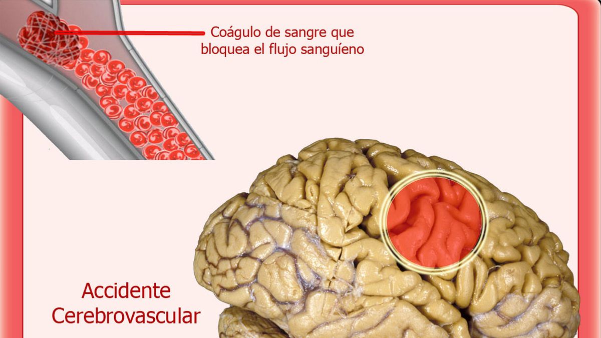 Aconsejan evitar los factores de riesgo de ACV y actuar con rapidez ...